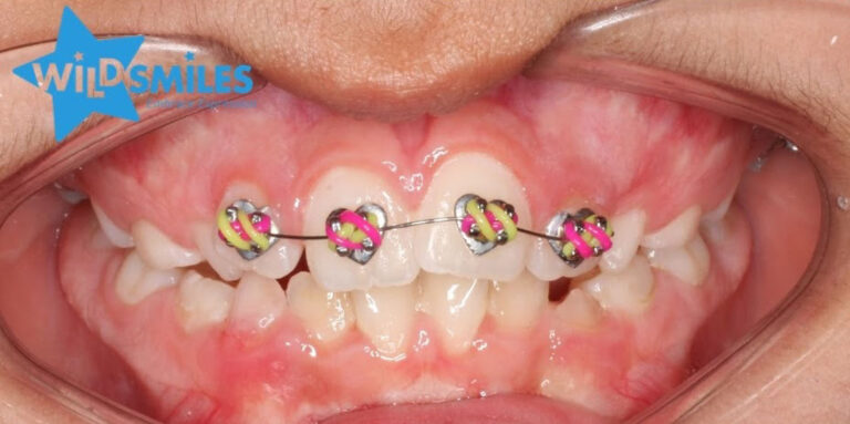 WildSmiles Braces in Las Vegas | Nevada Dentistry & Braces